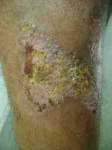 Pioderma gangrenoso. A propósito de un caso - Revista Electrónica de ...