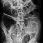 radiografia-abdomen-obstruccion-intestinal