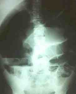 Vólvulo de sigmoides en un paciente joven, una presentación atípica ...