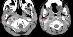 Absceso retrofaríngeo