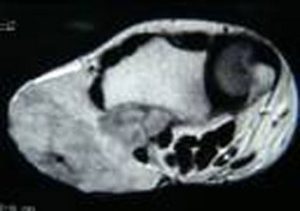 Condroma en radio distal. Caso clínico