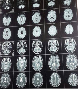 Síndrome de Sheehan. A propósito de un caso