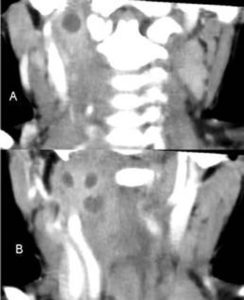 Absceso retrofaríngeo